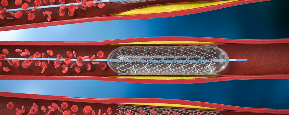 No mortality increase with paclitaxel-coated balloons and stents in ...