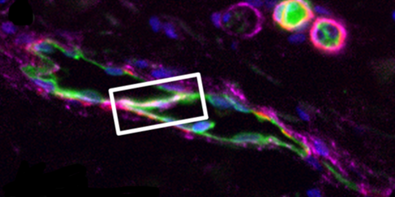 Metastases use divided blood vessels to grow | University of Gothenburg