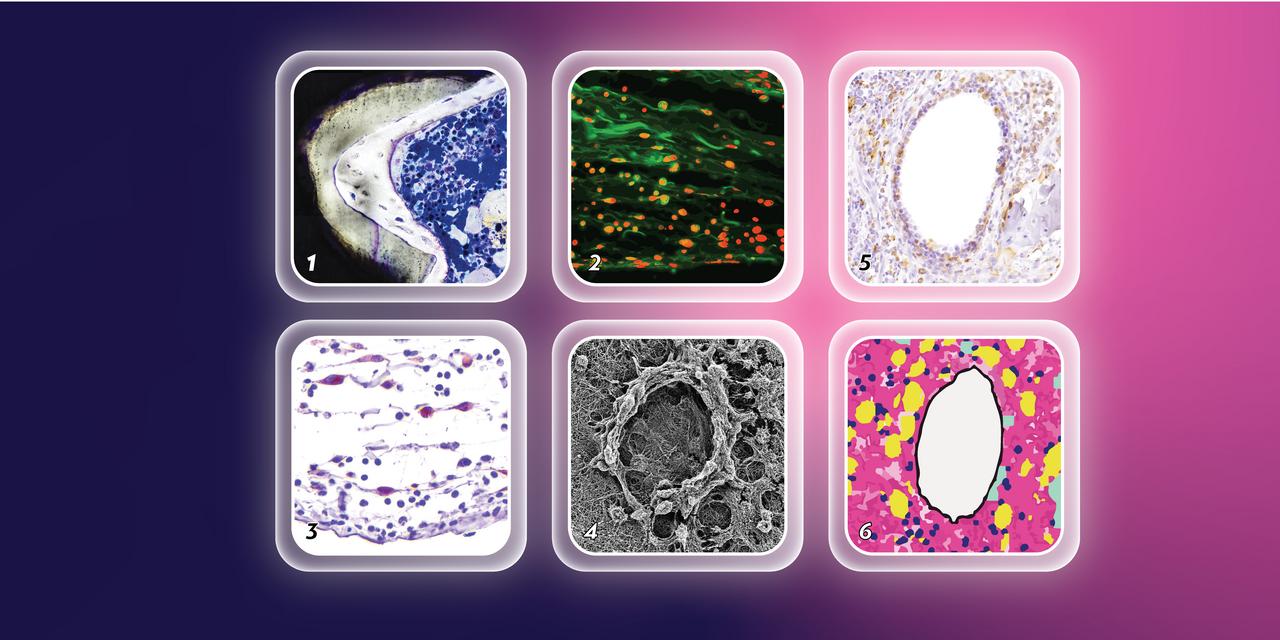 Heithem Ben Amara: Biodegradable implants and tissue healing ...